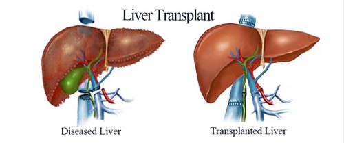 What Could Lead Up To A Liver Transplant Surgery?Medisetter